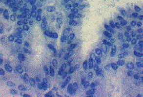 Breast papillary lesions: an analysis of 70 cases - ecancer