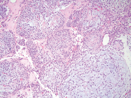 Myxoid mesenchymal neoplasm presenting as massive arm and chest wall ...