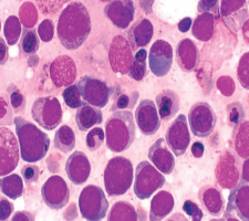 Study of clinical, haematological and cytogenetic profile of patients ...