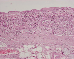 An unusual case of a glottic carcinoma metastasis to the tracheal lumen ...
