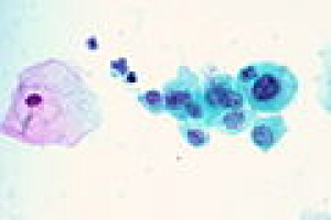 Detection of precancerous lesions in the cervix and HPV infection in ...