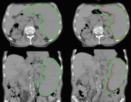 Palliative splenic irradiation for symptomatic splenomegaly in non ...