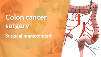 Surgical Management of Colonic Cancer - ecancer