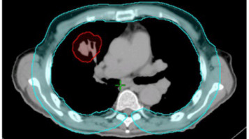 The emerging role of radiation therapists in the contouring of organs ...