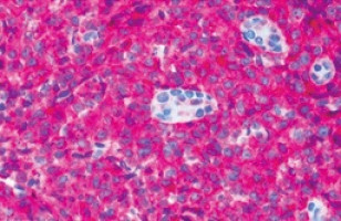 Myeloid sarcoma of the breast: a pathology that should not be forgotten ...