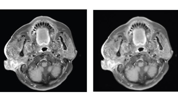 Plastic surgery and adjuvant chemoradiotherapy in the management of ...