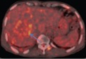 Metastatic sclerosing epithelioid fibrosarcoma in an adult male from a ...