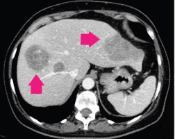 Precision medicine in the real-world setting. Clinical activity of talazoparib in a woman with ...