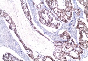 Diagnostic accuracy of SATB2 in identifying primary and metastatic ...