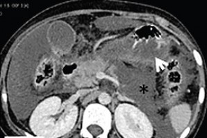 Role of CT in the detection and management of cancer related ...