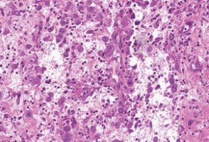 A mural nodule of anaplastic carcinoma with sarcomatoid differentiation ...