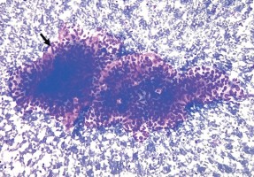 Solid/trabecular subtype of papillary thyroid carcinoma on cytology ...