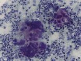 Primary signet ring cell carcinoma of the cervix: case report and ...