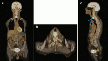 Esophageal squamous cell carcinoma in a patient with BRCA1 mutation: a ...
