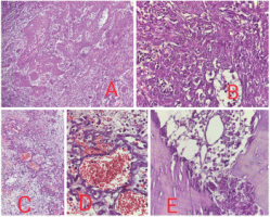 Pseudovascular squamous cell carcinoma of the buccal mucosa—a rare case ...