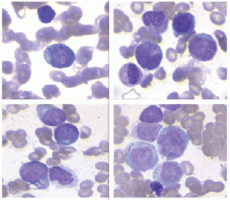 A 31-year-old male with a plasmacytoid dendritic blast cell neoplasm ...