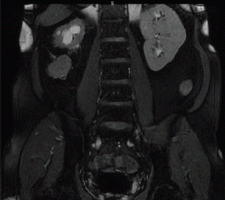 Squamous cell carcinoma of renal pelvis and percutaneous ...