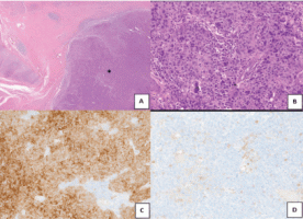 Lympho-epithelial carcinoma of the larynx – the big masquerader of ...