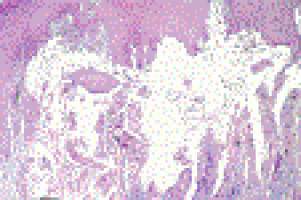 Literature meta-analysis of zosteriform cutaneous metastases from ...