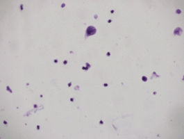 Haemorrhagic cystitis due to BK virus in a child with ALL on standard ...